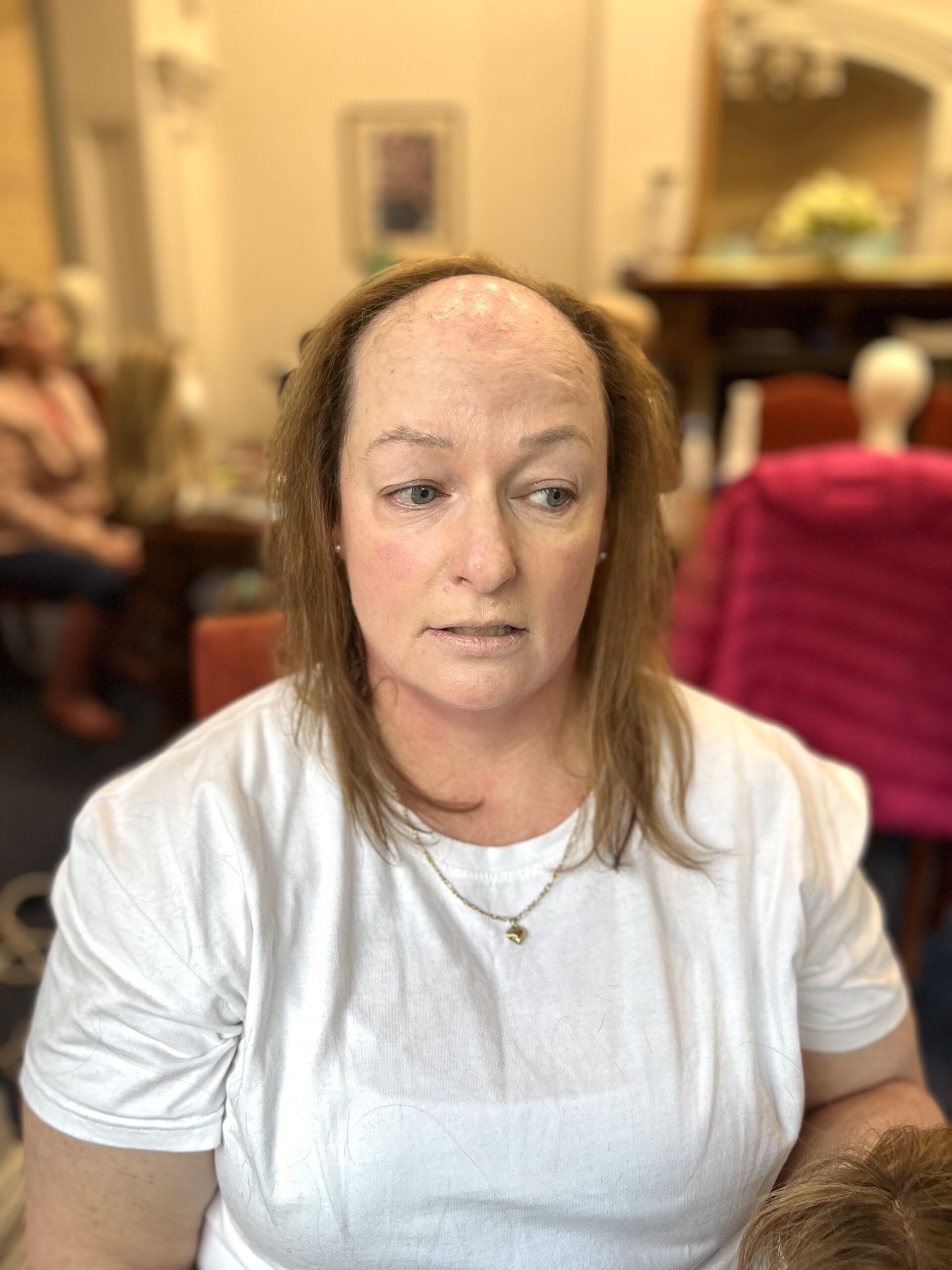Best Hair Loss Solutions For Frontal Fibrosing Alopecia (FFA) - The ...